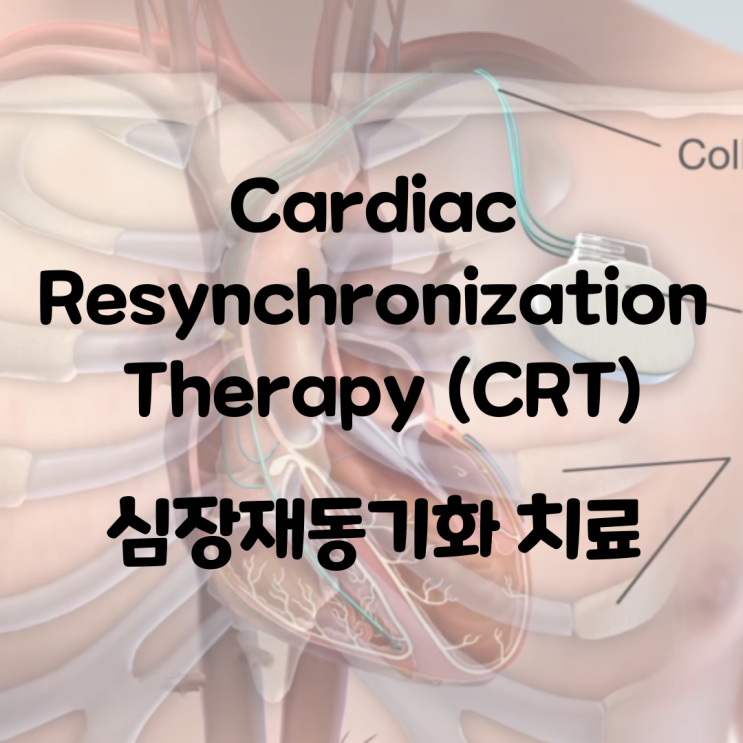 심장재동기화 치료 Cardiac resynchronization therapy, CRT-D, CRT-P (HF, LBBB, AV ...