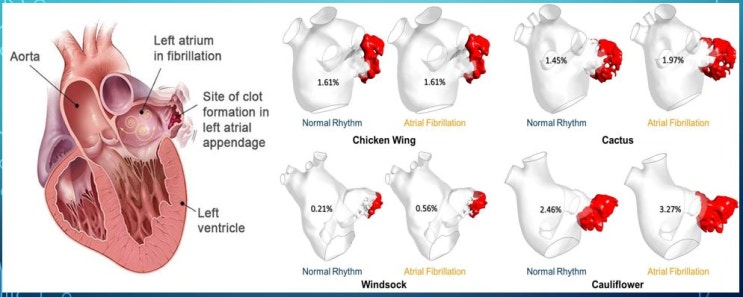 심방세동으로 인한 뇌졸중 감소를 위한 시술적 치료 -좌심방이 폐색술(LAAO, Left Atrial Appendage ...