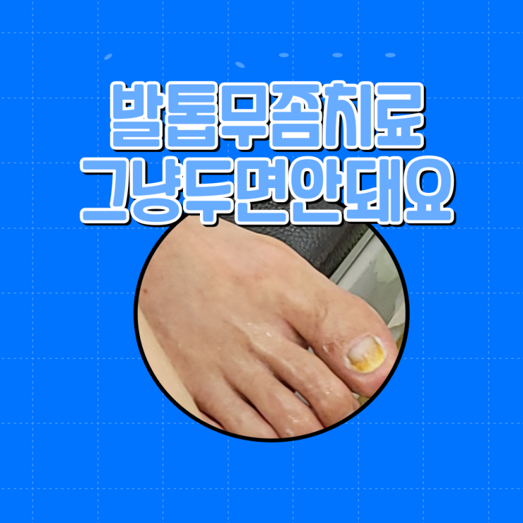 부산 개금네일 발톱무좀 치료 리체네일속눈썹 네이버 블로그