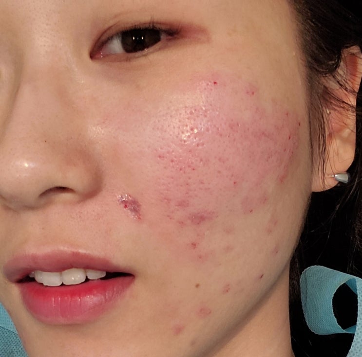 부산 서면 여드름 흉터 치료 새살침 리얼후기 3회차 네이버 블로그