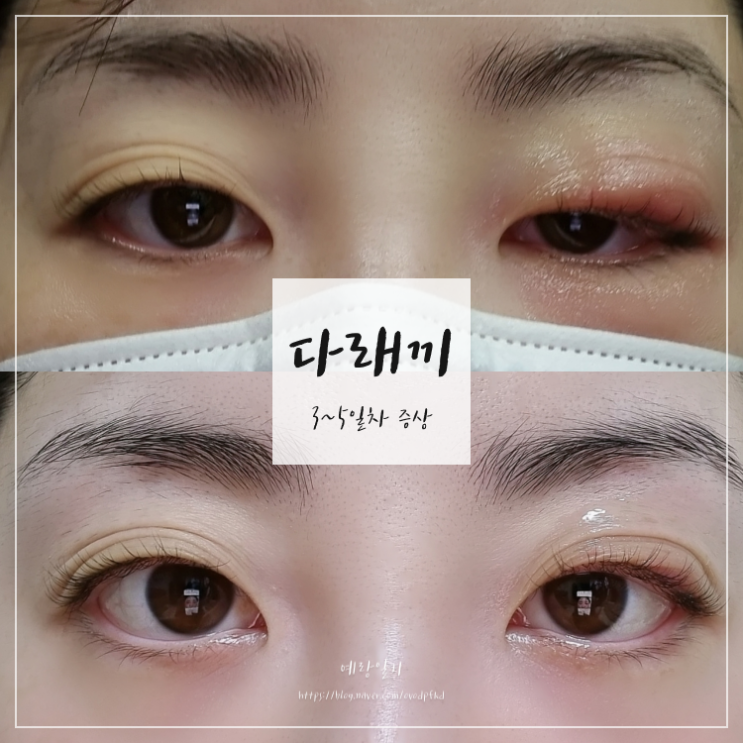 눈 다래끼 치료 후기 3~5일차 스테로이드성 항염증제 소염제 주사 붓기 증상 네이버 블로그