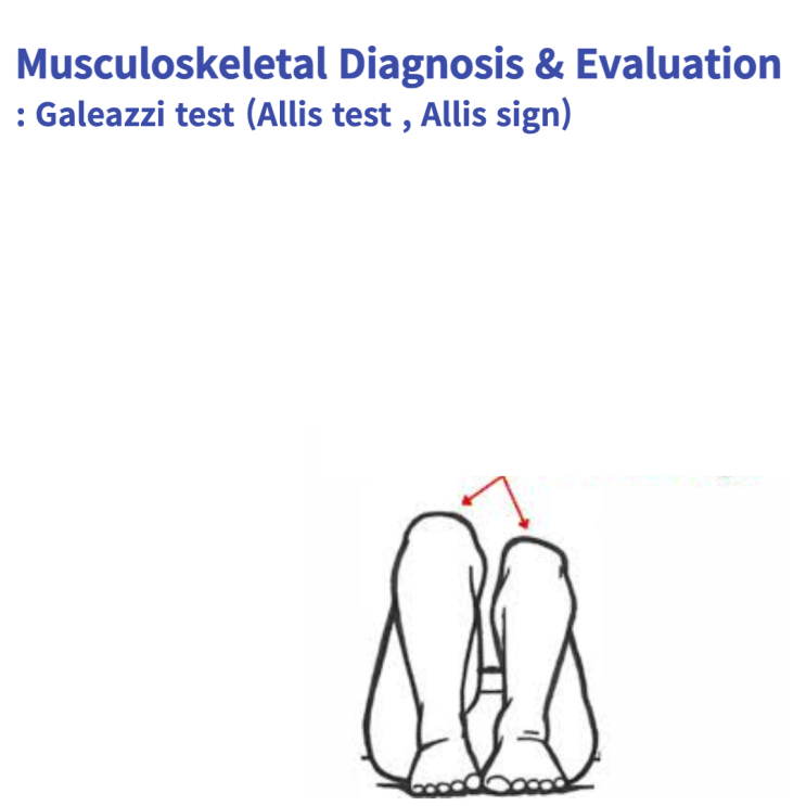 Galeazzi test (Allis test , Allis sign) : 갈레아찌 테스트 (앨리스 테스트) - 선천성 엉덩관절 ...