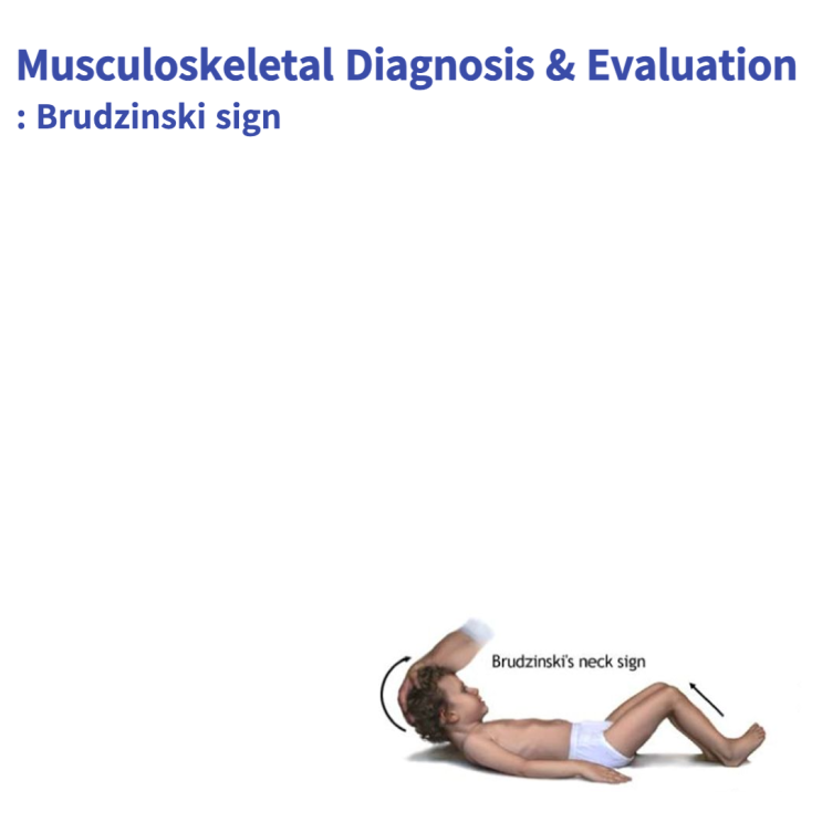 Brudzinski sign : 브루진스키 징조 - 뇌수막염 진단 : 네이버 블로그
