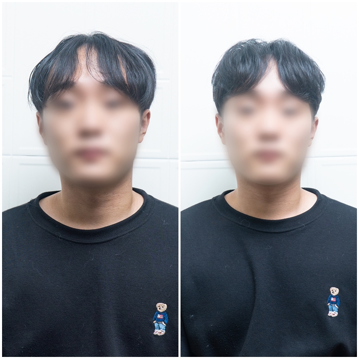 M자탈모 이마 넓은 남자 앞머리 헤어스타일 네이버 블로그