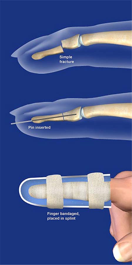 finger pinning/ fusion/ DIP arthrodesis : 네이버 블로그