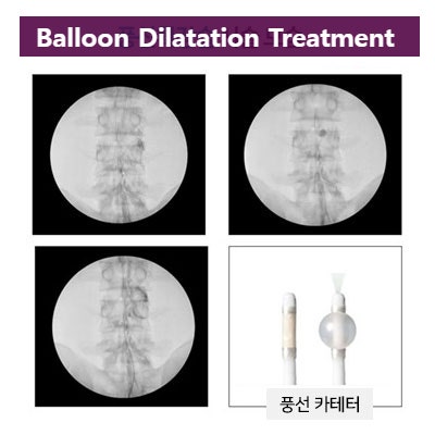 Treatment of Spinal Stenosis without Surgery - Balloon Dilatation ...