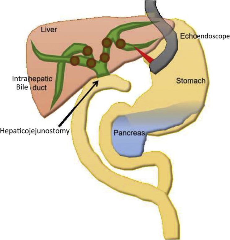 Hepaticojejunostomy 네이버 블로그