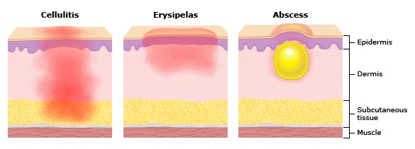 Acute cellulitis and erysipelas in adults: Treatment : 네이버 블로그