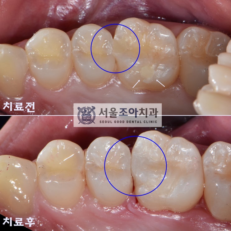 레진치료된 치아가 시큰하고 치실이 들어가지 않아 레진 빌드업으로 재치료한 증례 걸포동 충치치료 네이버 블로그