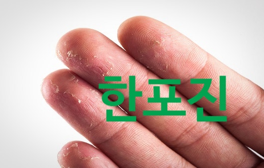 한포진 원인 발바닥 열감 손톱변형 손가락 수포 손바닥 가려움 물집 손발 발가락 포진 열감 발에 간지러움 생겼을때 체크 네이버 블로그