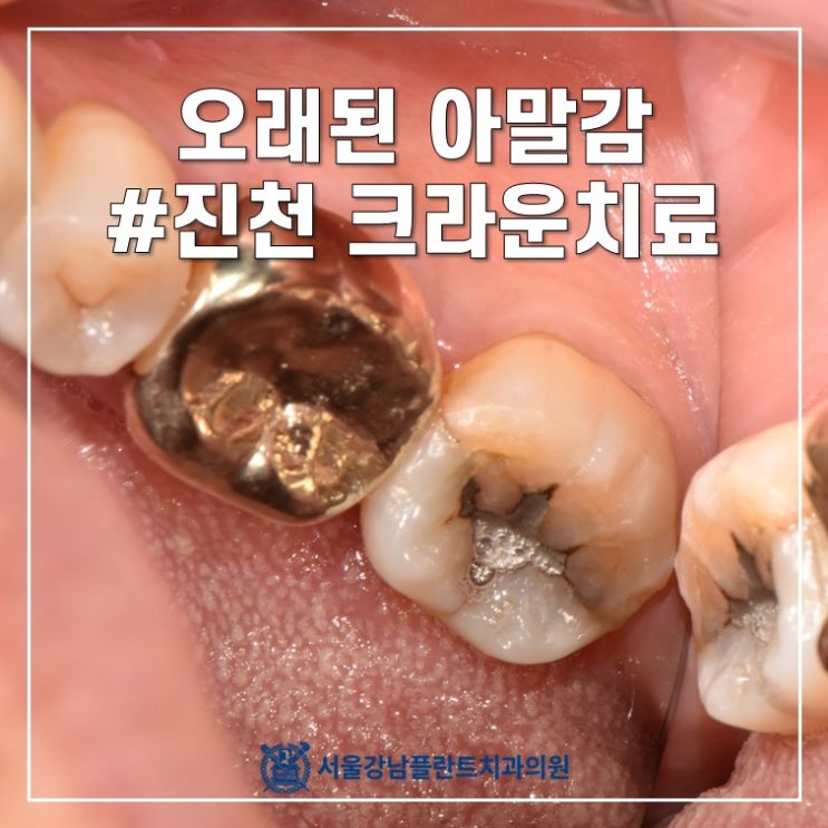 오래된 아말감 2차 우식 재치료 크라운 치료 네이버 블로그
