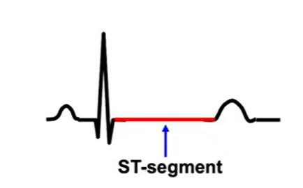 STEMI vs NSTEMI vs angina 와 ST segment elevation(상승) : 네이버 블로그