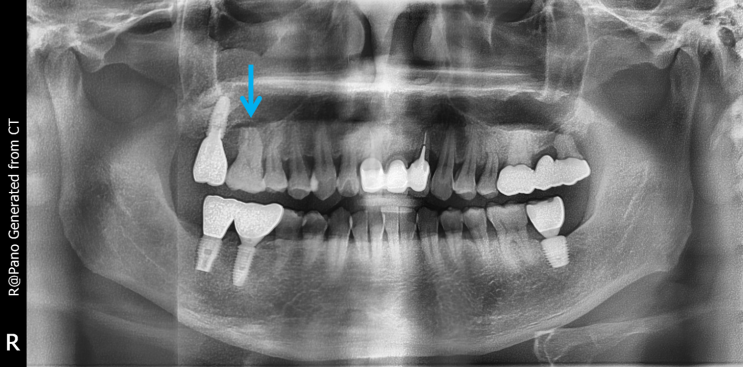 상악 제 1 대구치 발치 후 MagiCore 임플란트 식립 증례 : 네이버 블로그