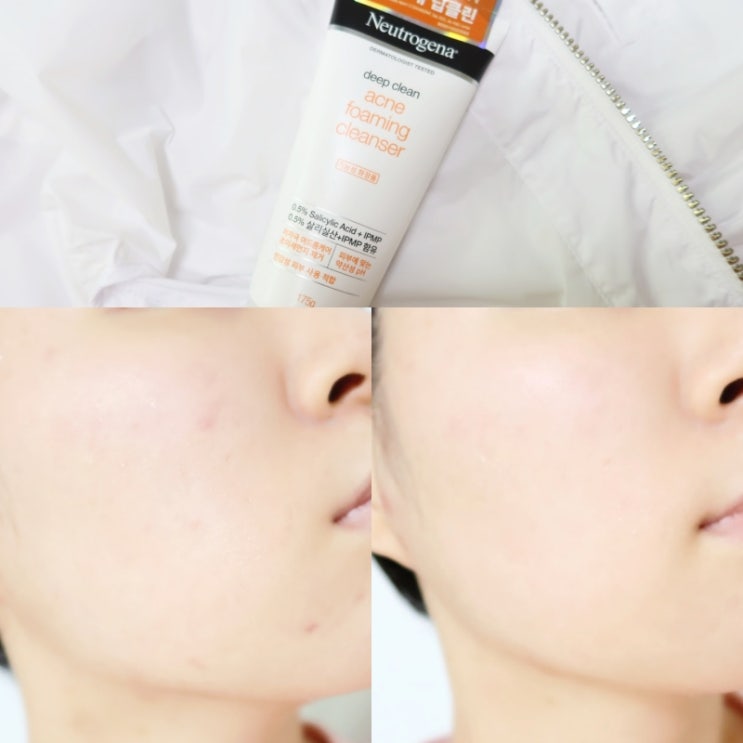 얼굴 여드름 피부 관리 폼클렌징 추천뉴트로지나 3주 후기 네이버 블로그