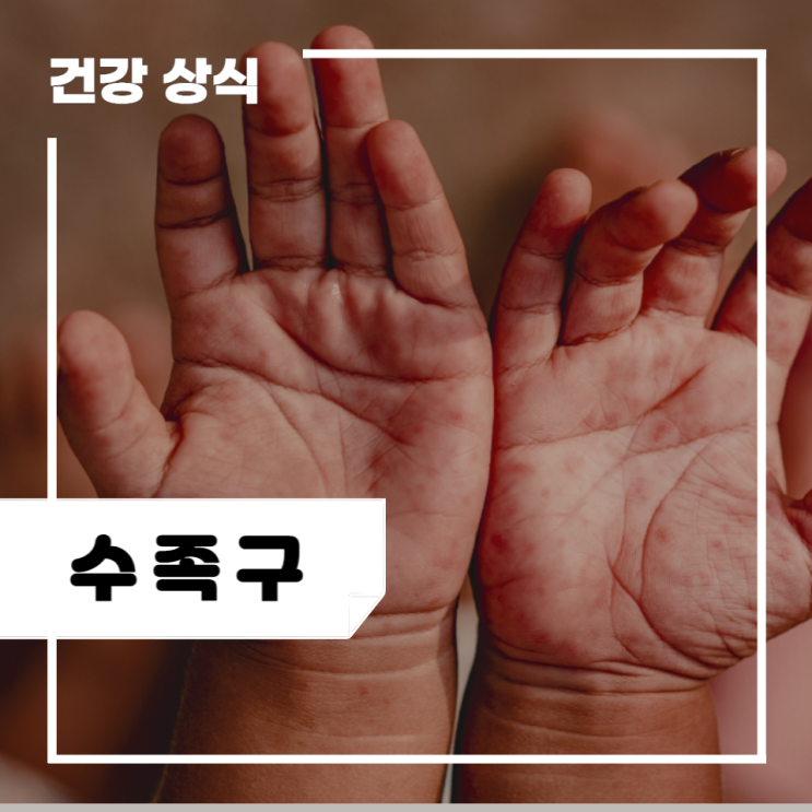 수족구 병 초기 증상 및 원인 잠복기 전염전염성 기간 경로 치료약 연고 예방 수포 관리 병원 성인