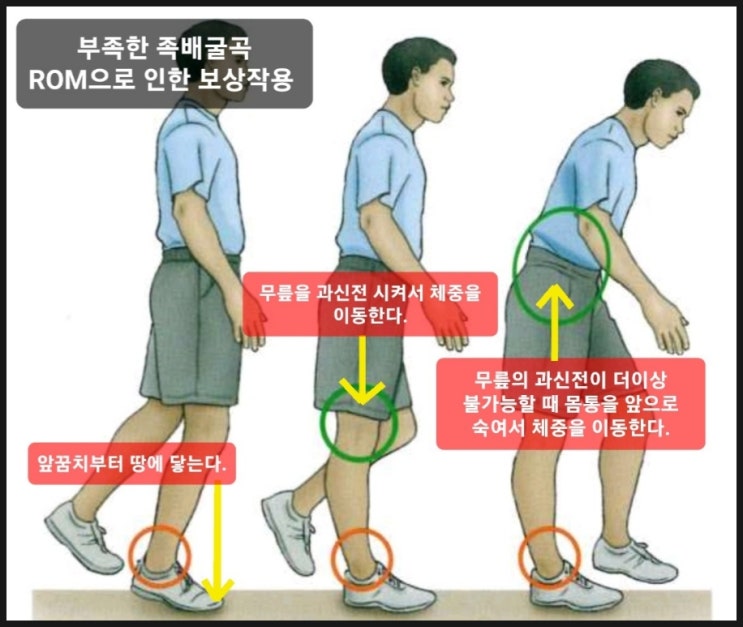 반장슬(Genu recurvatum)과 족배굴곡, 족저굴곡의 상관관계 : 백니(Back knee) 원인과 교정 : 네이버 블로그