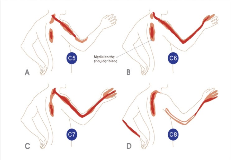 목(상지) - 피부분절 Dermatome, 근육분절 myotome : 네이버 블로그