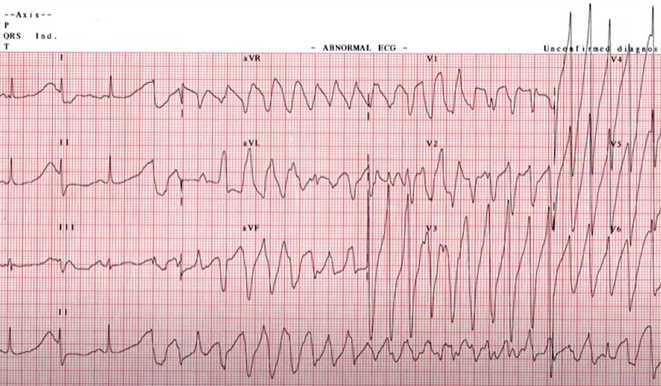 polymorphic ventricular tachycardia : PMVT, 다형성 심실빈맥 : 네이버 블로그