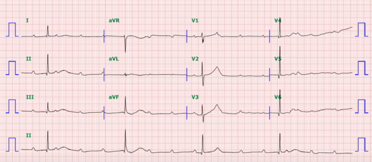 complete AV block , 3도 AV block : 네이버 블로그