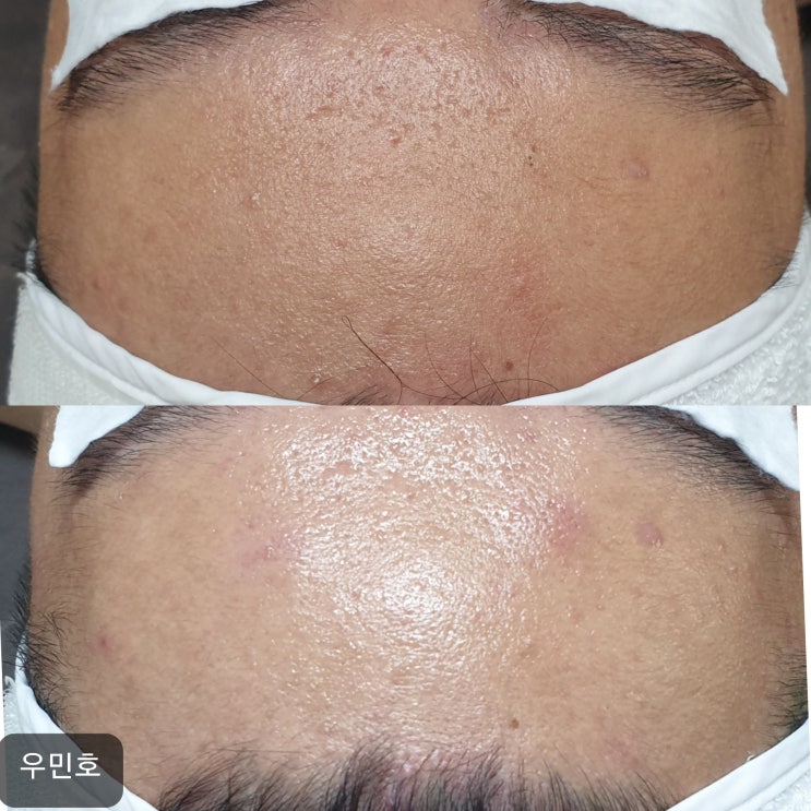 영등포피부관리 신도림여드름관리 만족스러워요 네이버 블로그