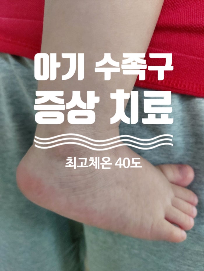 19개월 아기 수족구 증상 및 치료 후기고열 수포 발진 음식거부 네이버 블로그