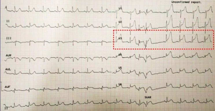 심장초음파와 심전도 ( EKG ) : 네이버 블로그