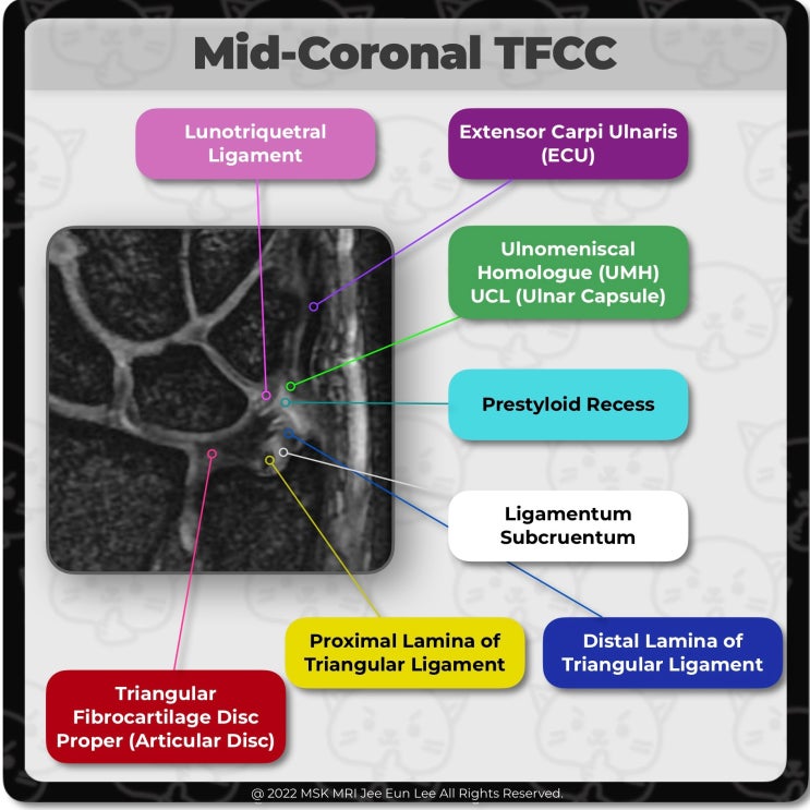 [Anatomy_16] Radioulnar Component of ulnomeniscal homologue, TFCC ...
