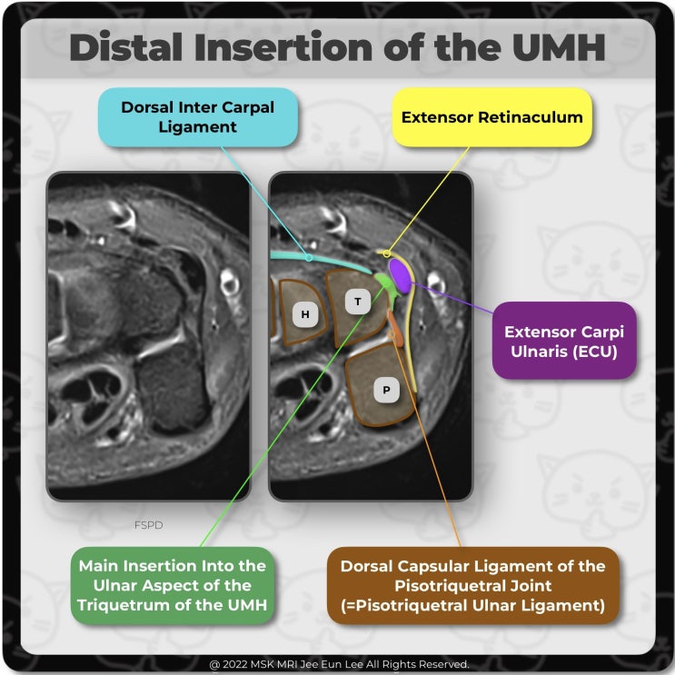 [Anatomy_19] Distal Insertion of the ulnomeniscal homologue, TFCC ...