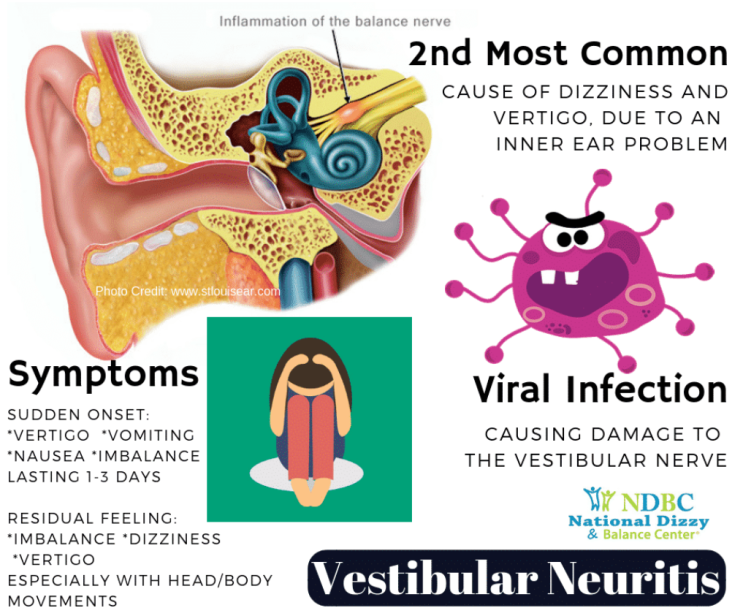 어지러움 - Vestibular neuritis(VN, 전정신경염) : 네이버 블로그