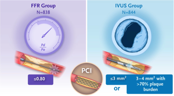 PCI 여부 결정을 위한 FFR과 IVUS 비교 (FLAVOUR Clinical Trials) : 네이버 블로그