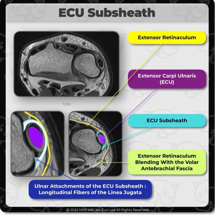 [Anatomy_20] Extensor carpi ulnaris (ECU) subsheath complex, Linea ...