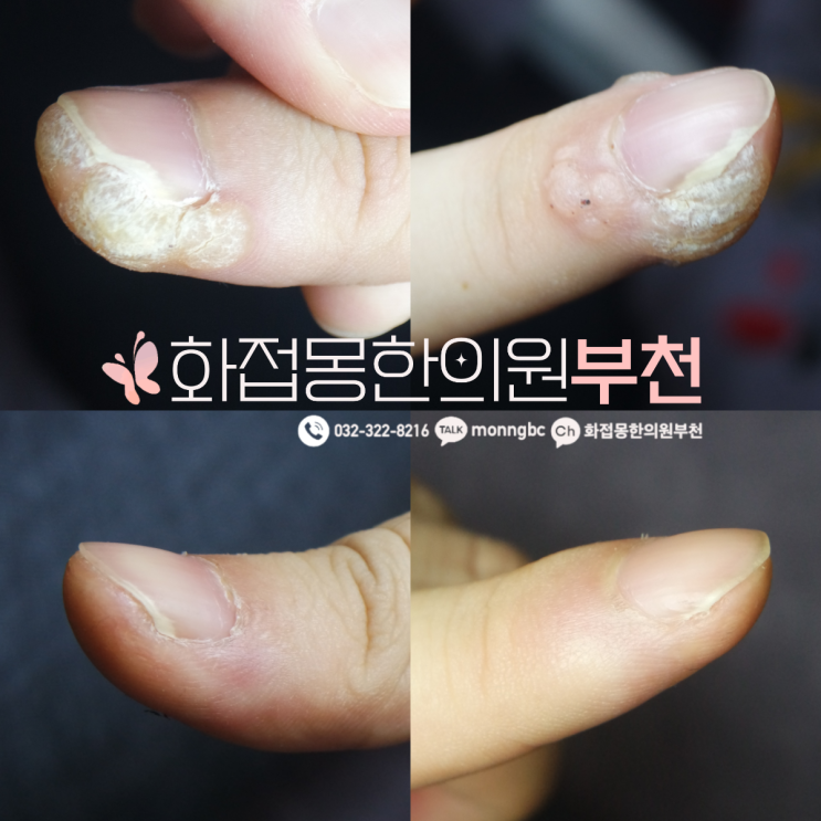 [사마귀] 부천손톱사마귀 부천손가락사마귀 부천손사마귀, 손가락 냉동치료가 너무 힘들어요 다른 치료 방법은 없을까요? 1:1맞춤치료 1인실진료 부천한의원 : 화접몽한의원부천점 ...