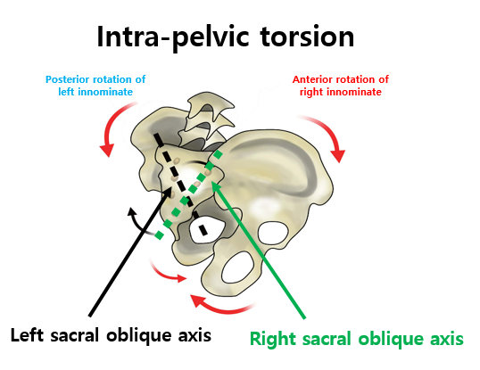 골반내 비틀림(Intra-pelvic torsion)과 연관된 천골 비틀림(Sacral torsion) - 추나요법 및 골반 ...