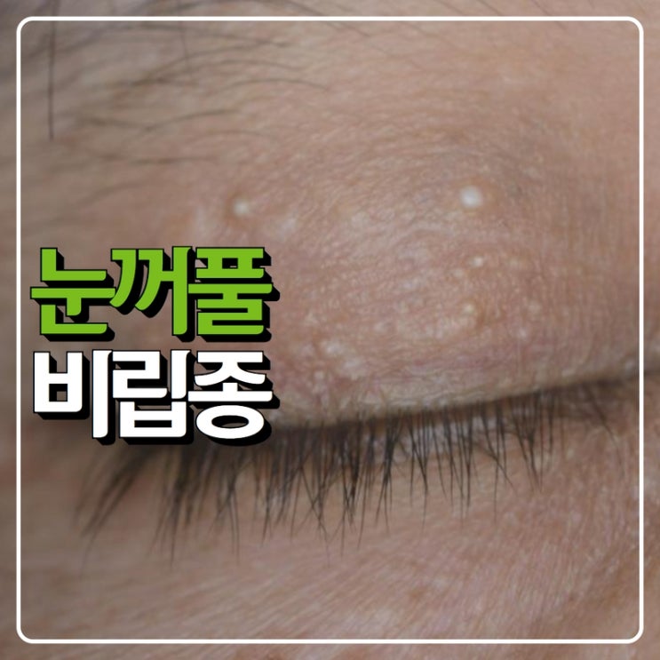 눈밑 눈꺼풀 비립종 원인 제거 가격 네이버 블로그
