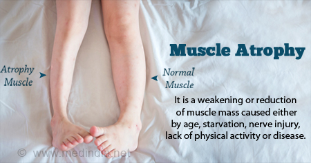 Muscle atrophy (근 위축) : 네이버 블로그