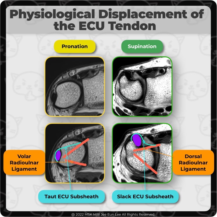 [Anatomy_21] Physiologic displacement of the extensor carpi ulnaris ...