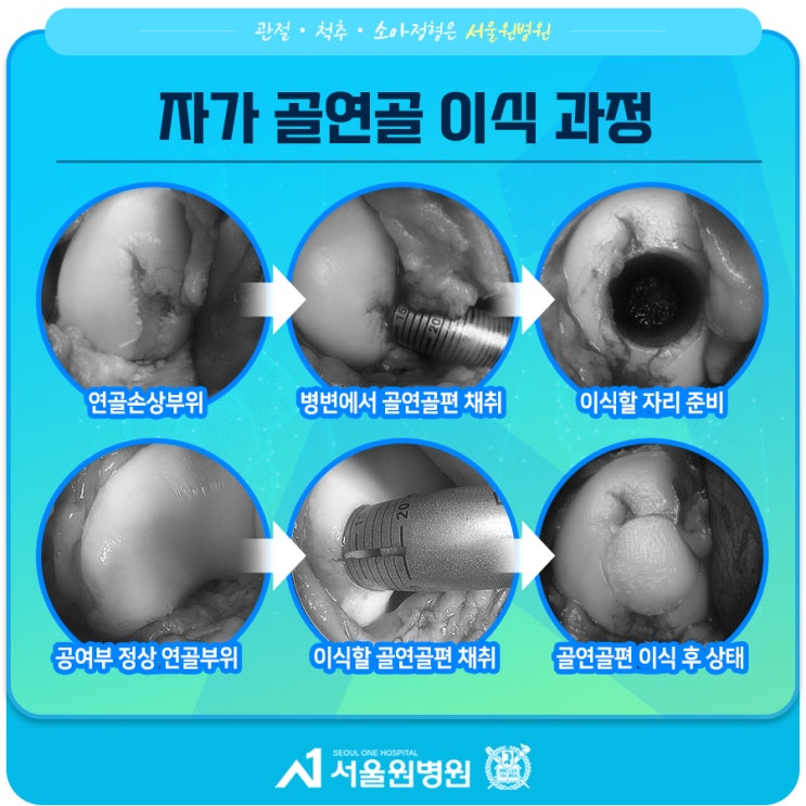 강서구 정형외과 무릎 연골재생을 위한 자가골연골이식술이란 무엇일까요 네이버 블로그