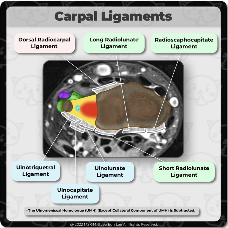 [Anatomy_24] Carpal Ligaments, Triangular fibrocartilage complex (TFCC ...