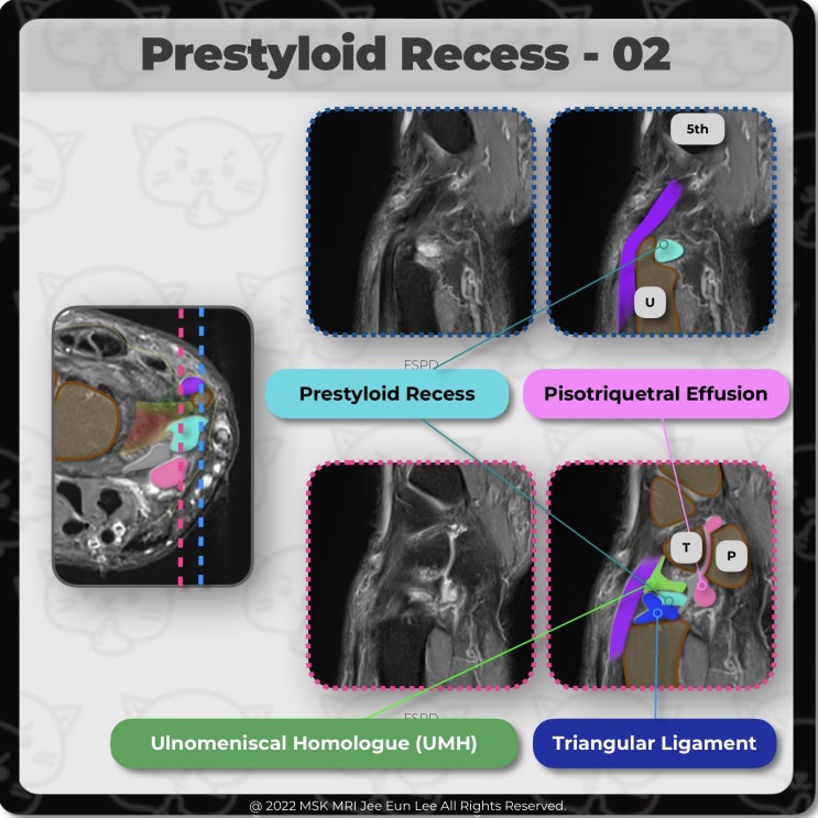 [Anatomy_26] Prestyloid Recess, ulnotriquetral ligament, Ulnomeniscal ...