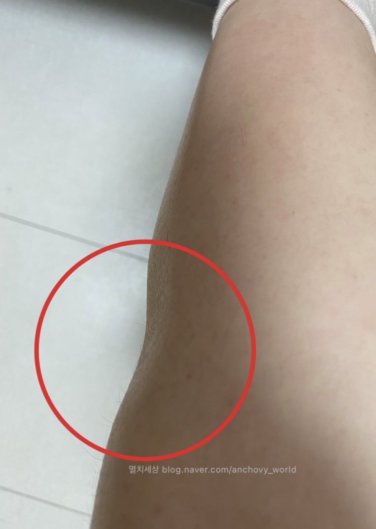 내가 임신중독이라니임신중독증 증상 응급제왕절개 출산가방 네이버 블로그