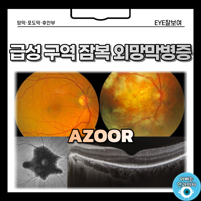급성 구역 잠복 외망막병증(AZOOR): 정의, 원인, 발병기전, 증상, 소견, 진단, 치료, 예후 : 네이버 블로그