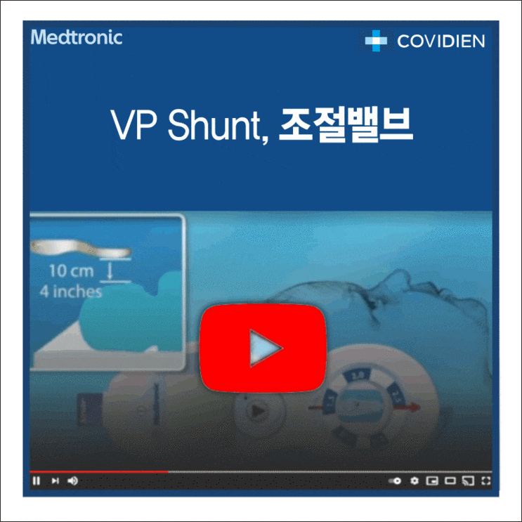 [동영상] VP Shunt, 조절밸브(Strata™ Adjustable Valve)작동 동영상 : 네이버 블로그