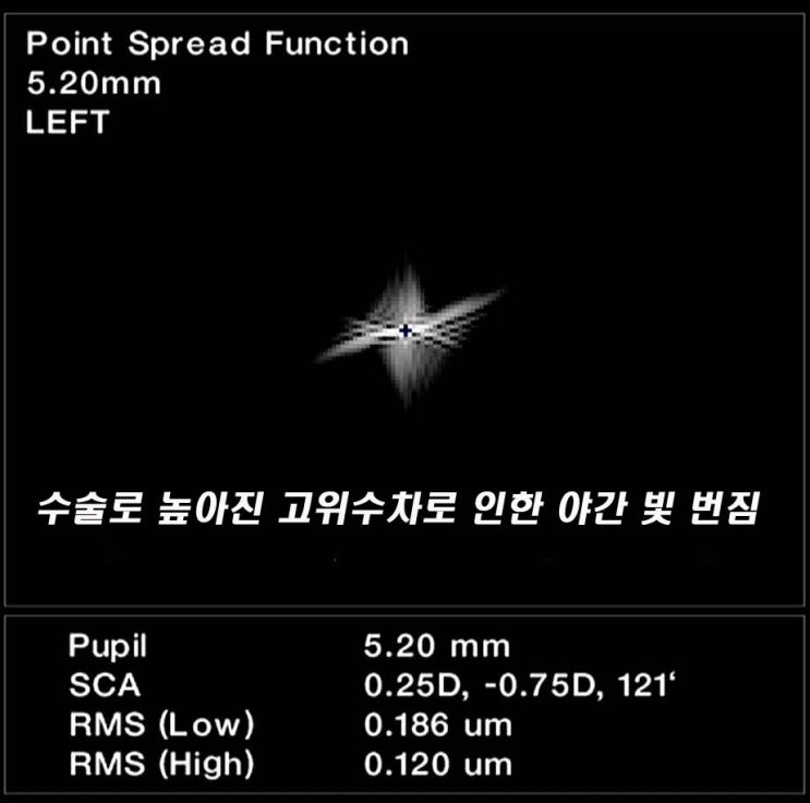 스마일 라식수술 후 나타난 야간 빛 번짐의 위한 보안경 네이버 블로그