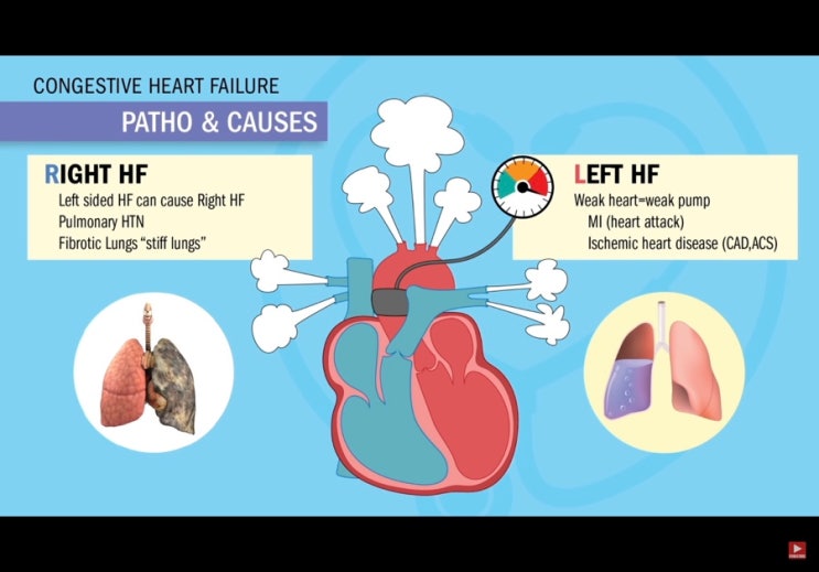 의학용어 CHF (울혈성 심부전)& Pneumonia & Pleural effusion & 폐부종 비교 공부하기 : 네이버 블로그