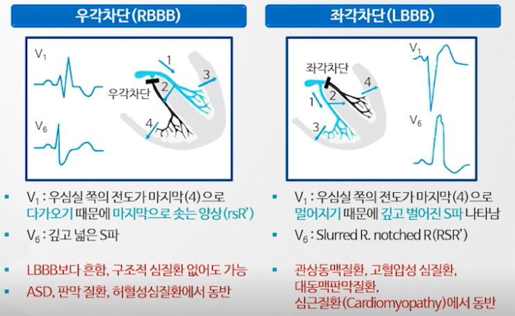 심전도 : 각차단-RBBB/LBBB : 네이버 블로그