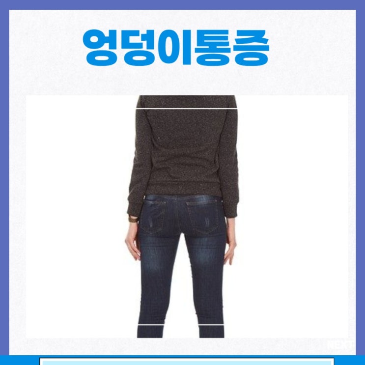 엉덩이 통증 치료 방법 고관절 엉치뼈통증 원인 척추관 협착증 천골염 고관절 대퇴비구 충돌증후군 네이버 블로그