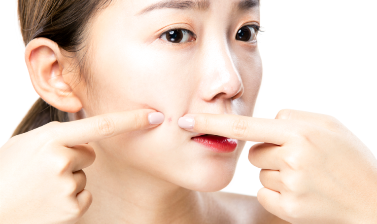 고양시 일산동구 피부과전문의가 알려드리는 좁쌀면포성 여드름 치료법 네이버 블로그
