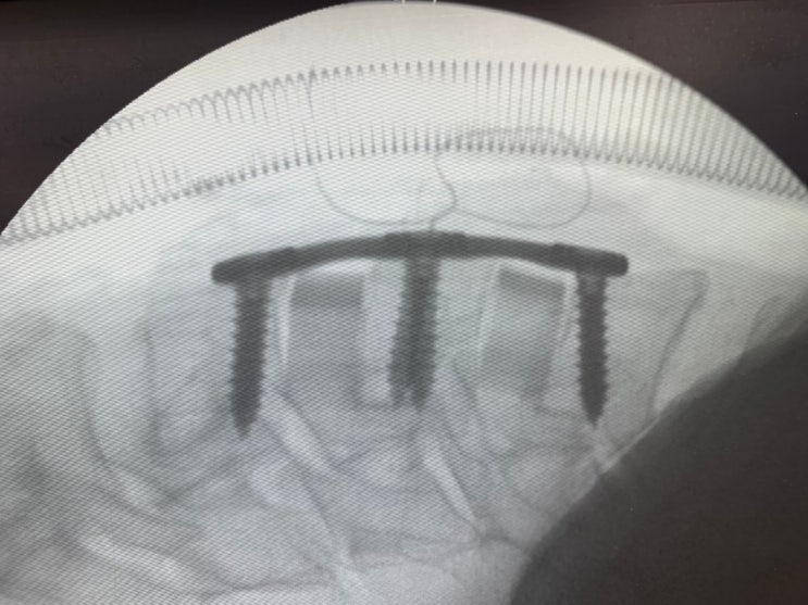 NS ACDF, Corpectomy : 네이버 블로그