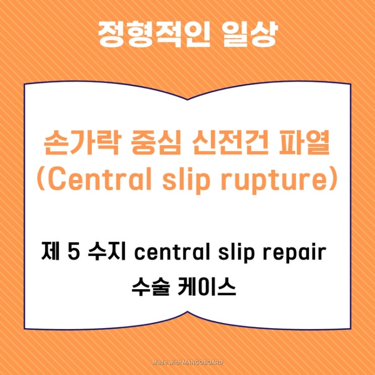 손가락 Button hole 변형, (Bouttenniere Deformity) - 손가락 신전건(central slip ...