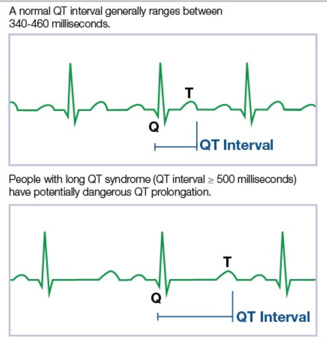 Long QT syndrome (QT간격 연장 증후군) Torsades de pointes : 네이버 블로그